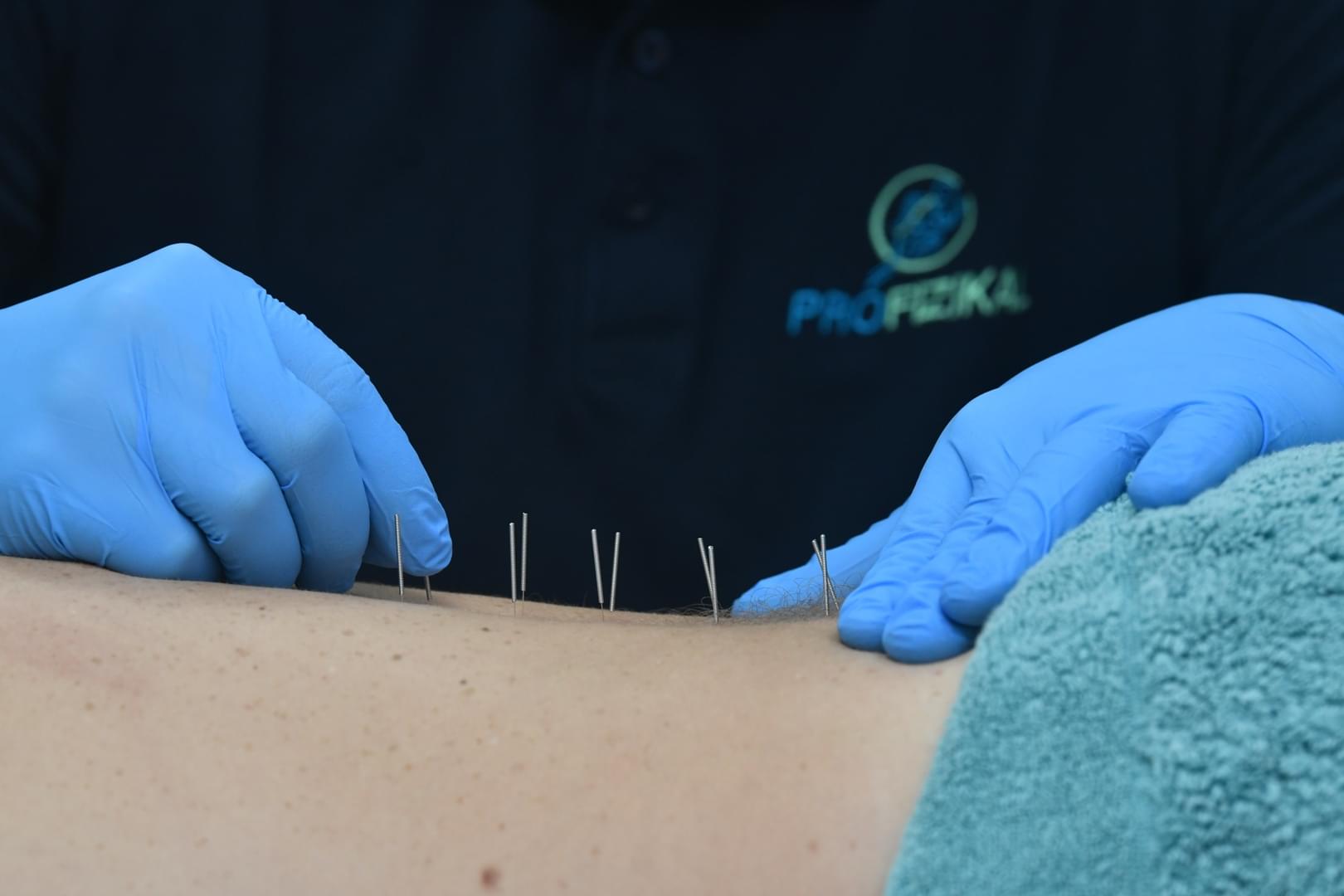 Akupunktura Novi Beograd - Profizikal